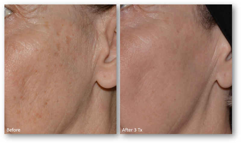 Lase MD Ultra Facial Resurfacing Treatment - Advanced Dermatology and ...